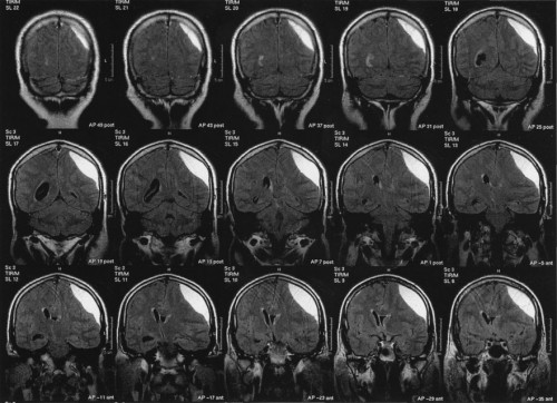 subdurales Hämatom | Medizin | Repetico